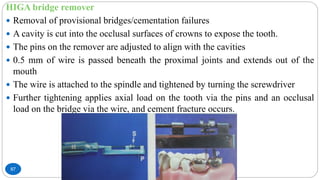 Failures in Fixed Partial Denture | PPTX
