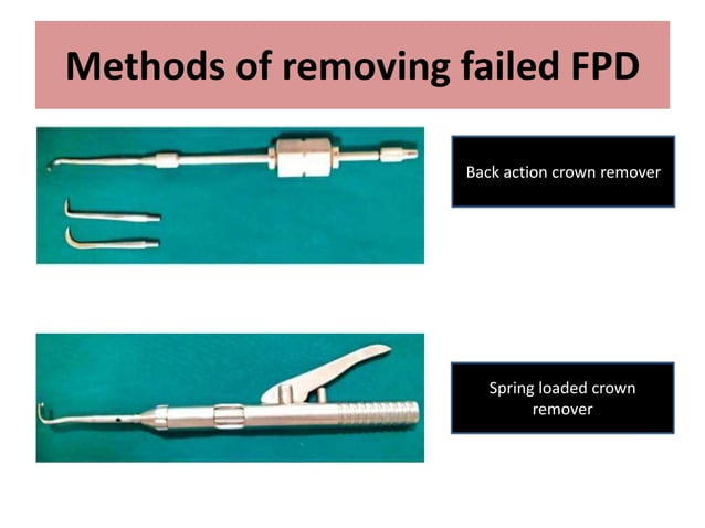 Failures in FPD.pptx | Dental Health | Diseases and Conditions