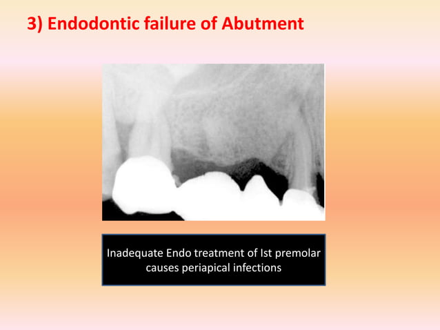 Failures in FPD.pptx | Dental Health | Diseases and Conditions