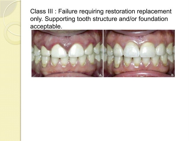 Failures in FPD and their management.pptx