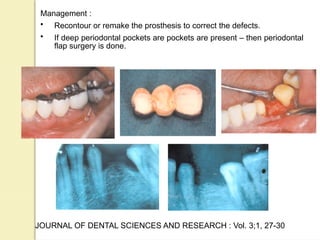Failures in FPD and their management.pptx