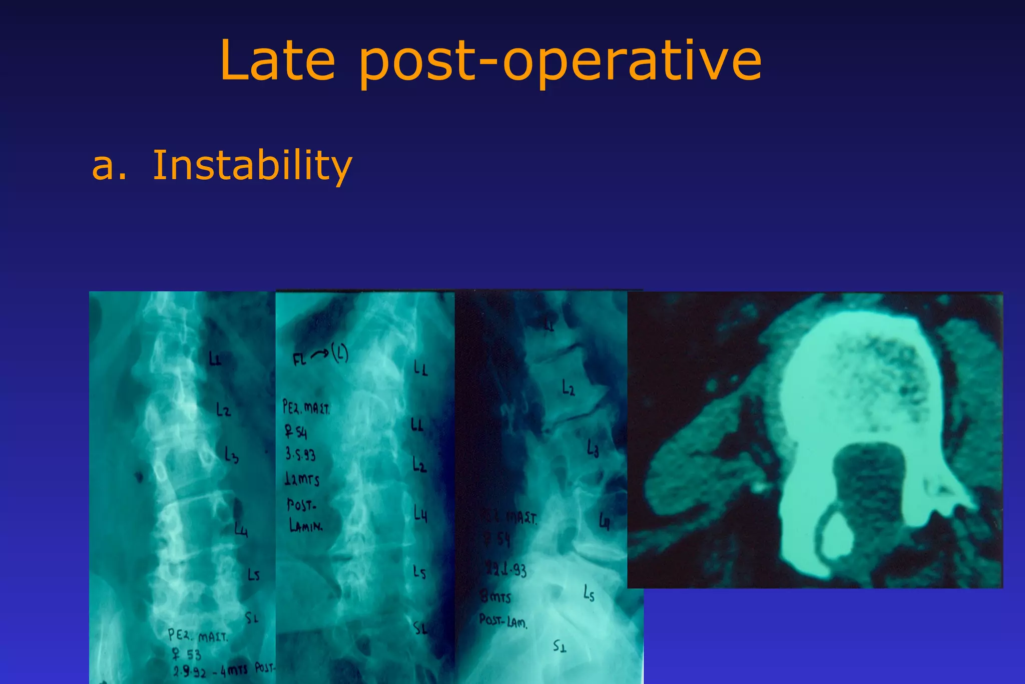 Lumbar Instability Causes - Diagnosis - Management | PPT