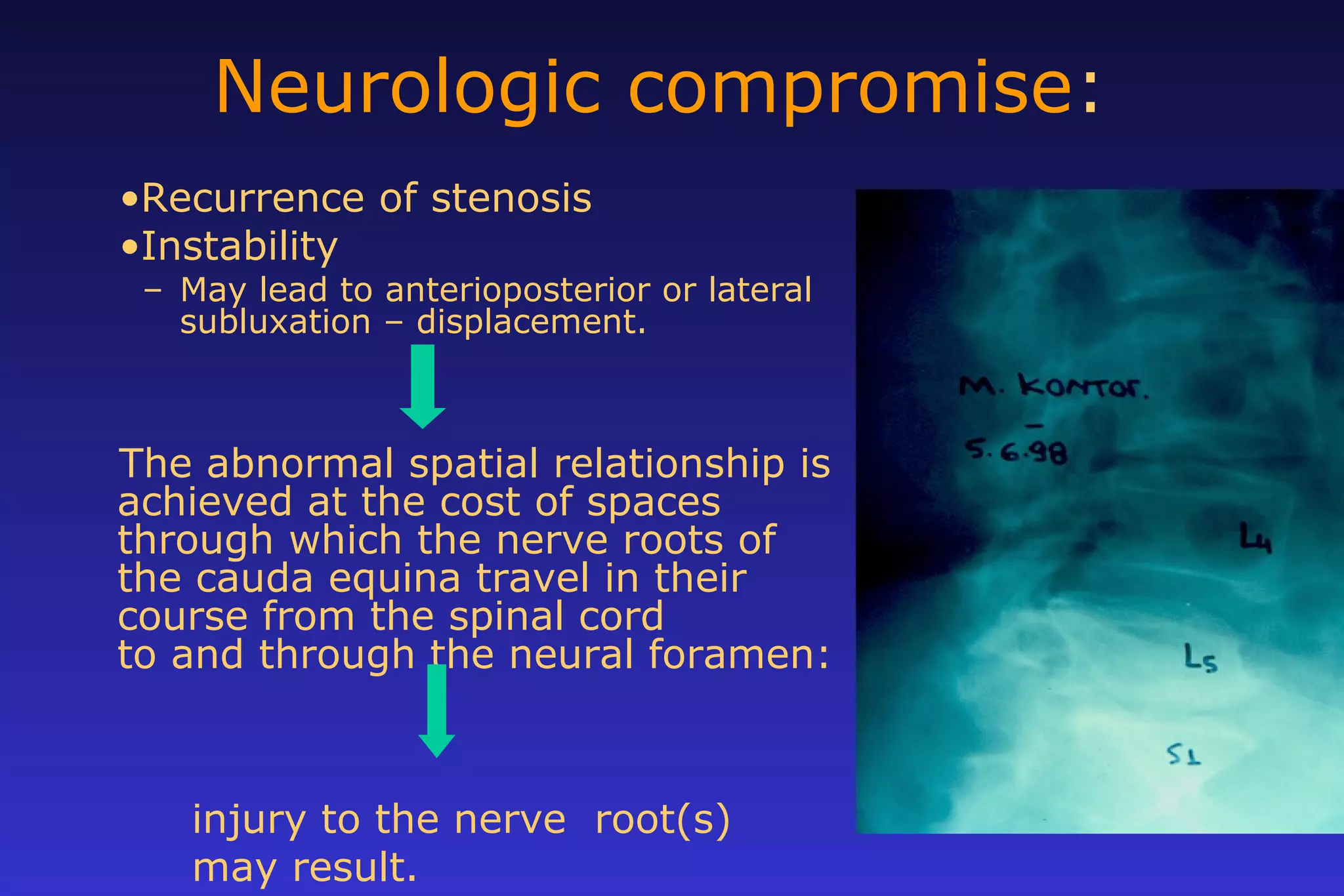 Lumbar Instability Causes - Diagnosis - Management | PPT