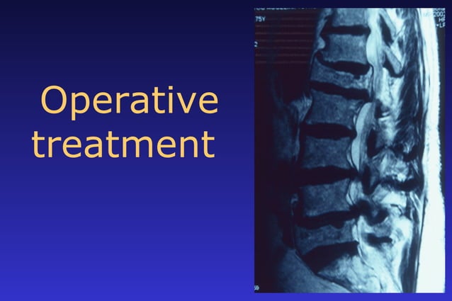 Lumbar Instability Causes - Diagnosis - Management | PPT | Bone and ...