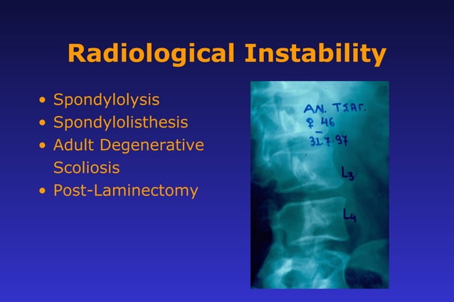 Lumbar Instability Causes - Diagnosis - Management | PPT | Bone and ...