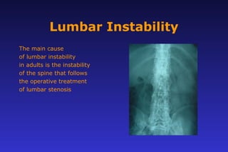 Lumbar Instability Causes - Diagnosis - Management | PPT