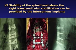 Lumbar Instability Causes - Diagnosis - Management | PPT