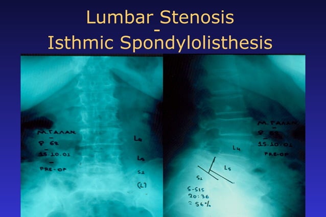 Lumbar Instability Causes - Diagnosis - Management | PPT | Bone and ...