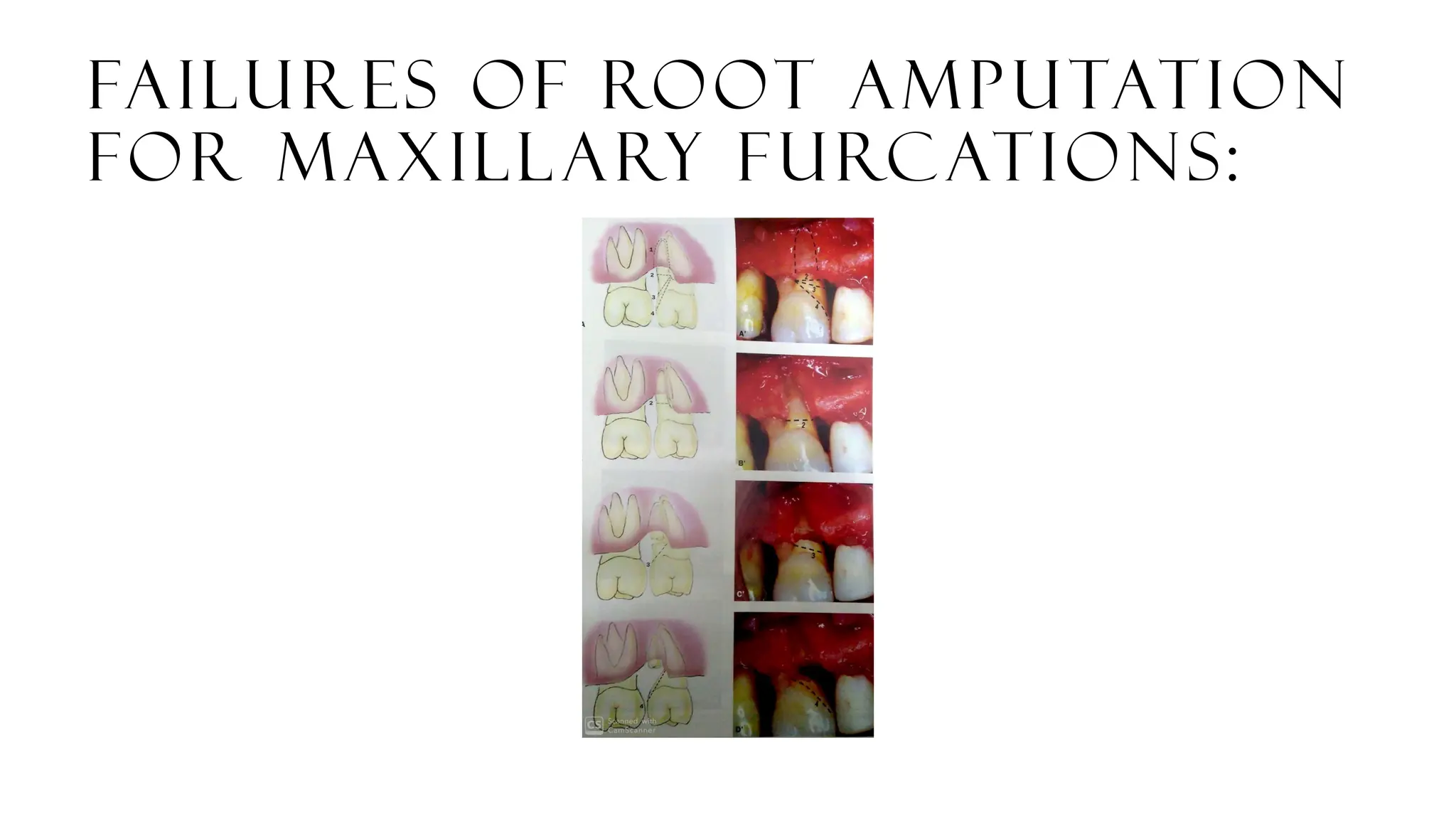 Failures of periodontal therapy .pptx