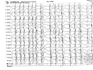 Continuous spike and wave during slow wave sleep(CSWS) | PPT