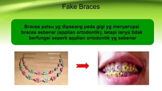 Fake braces | PPTX