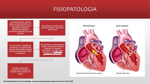 Falla cardiaca aguda