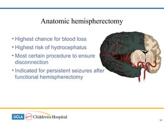 Hydrocephalus After Hemispherectomy And Other Resective Procedures | PPT