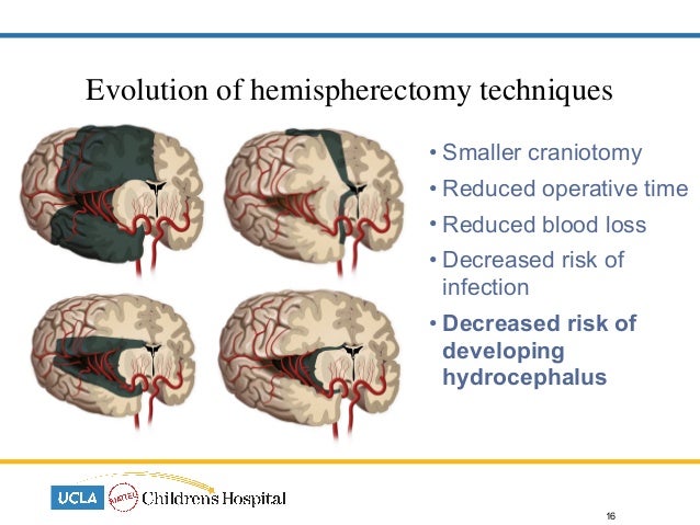 Hydrocephalus After Hemispherectomy And Other Resective Procedures