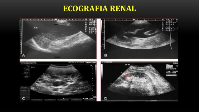 NEFROLOGIA CLINICA: Falla renal aguda