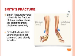 Fall on an outstrtched hand | PPT