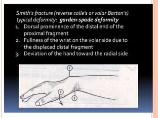 Fall on an outstrtched hand | PPT