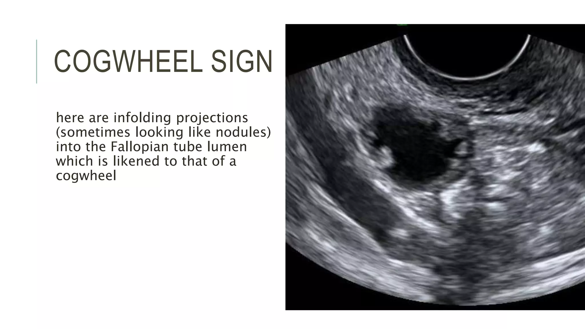 Fallopian tube Imaging Radiology | PPTX