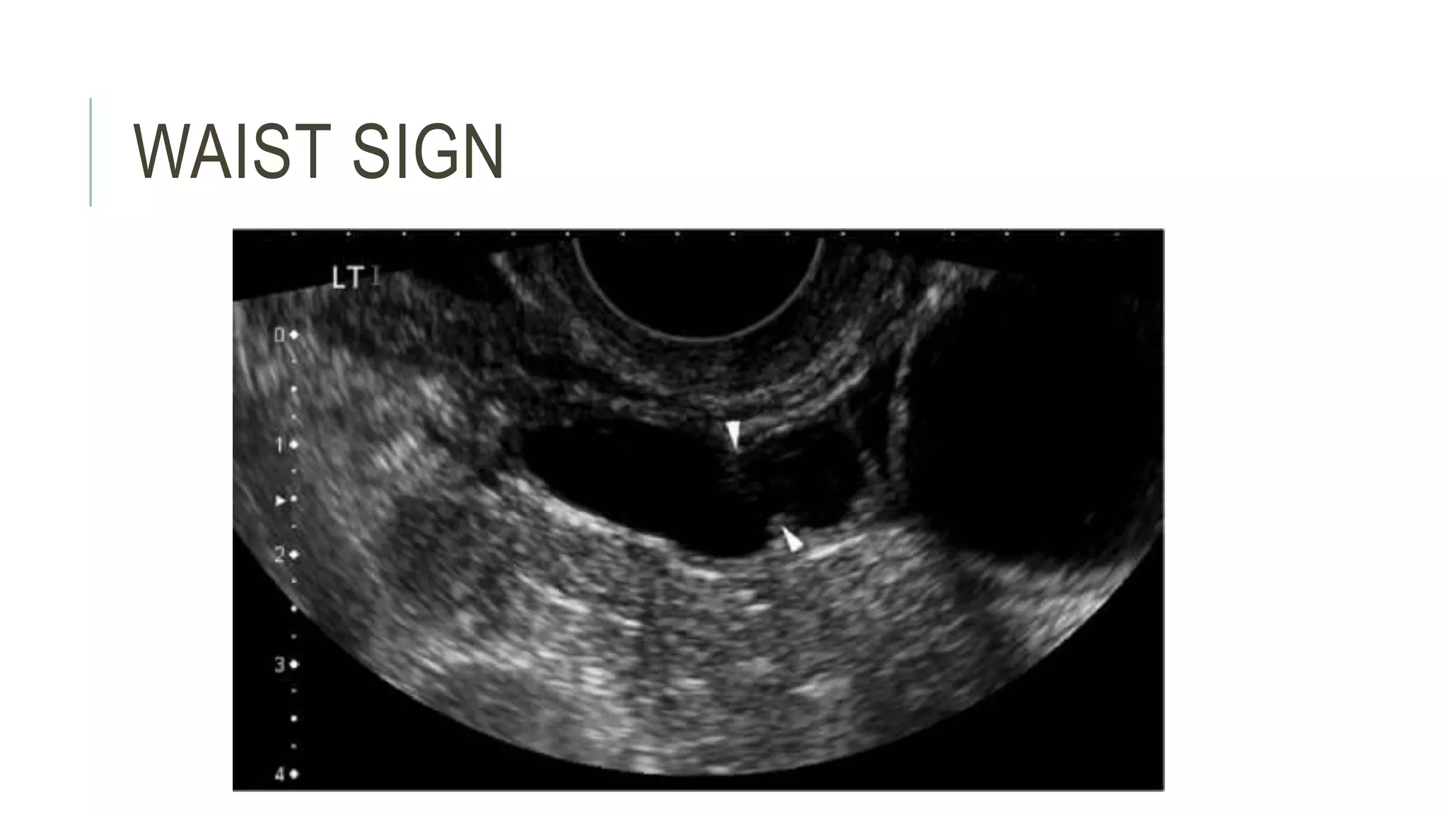 Fallopian tube Imaging Radiology | PPTX