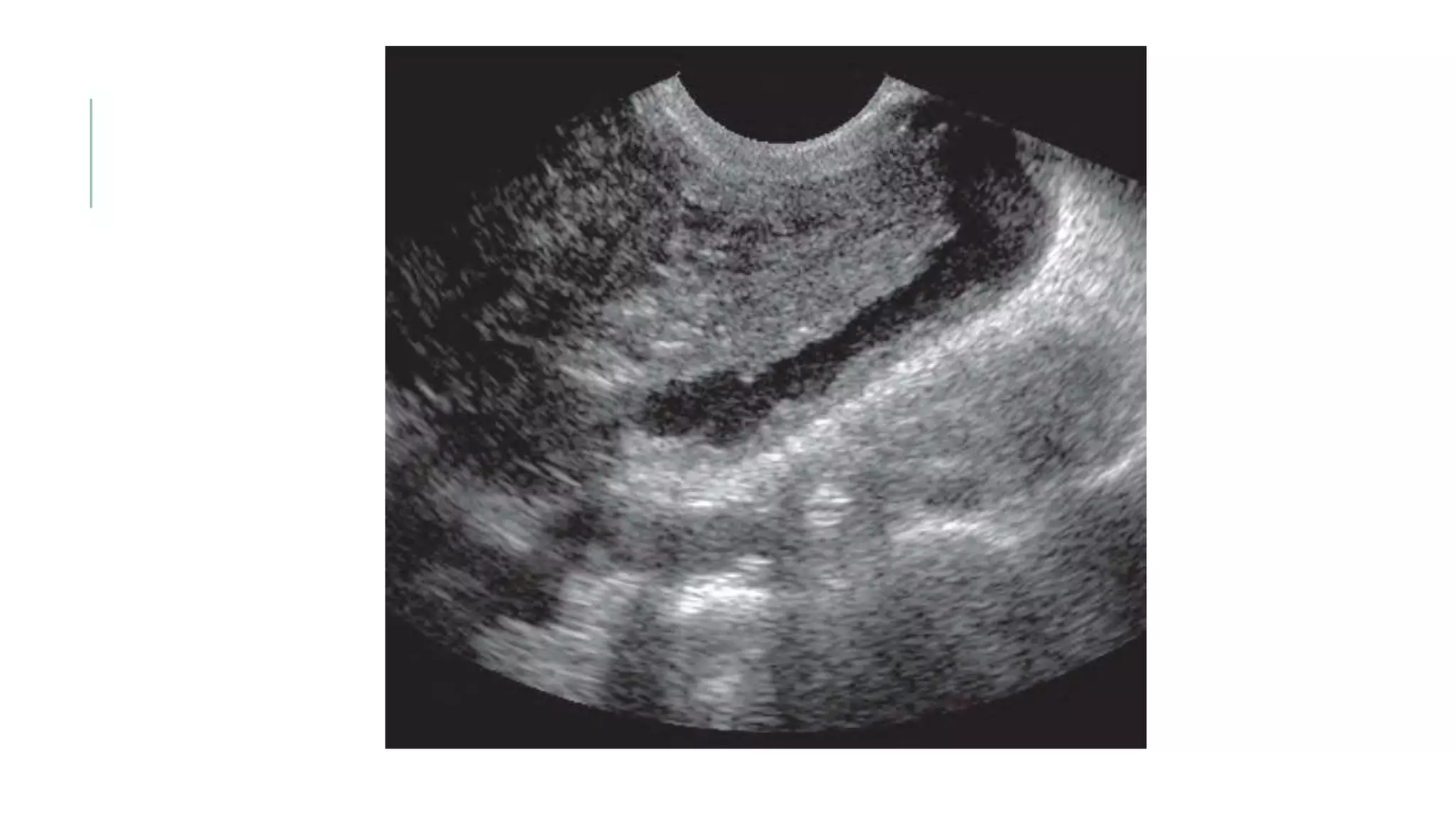 Fallopian tube Imaging Radiology | PPTX