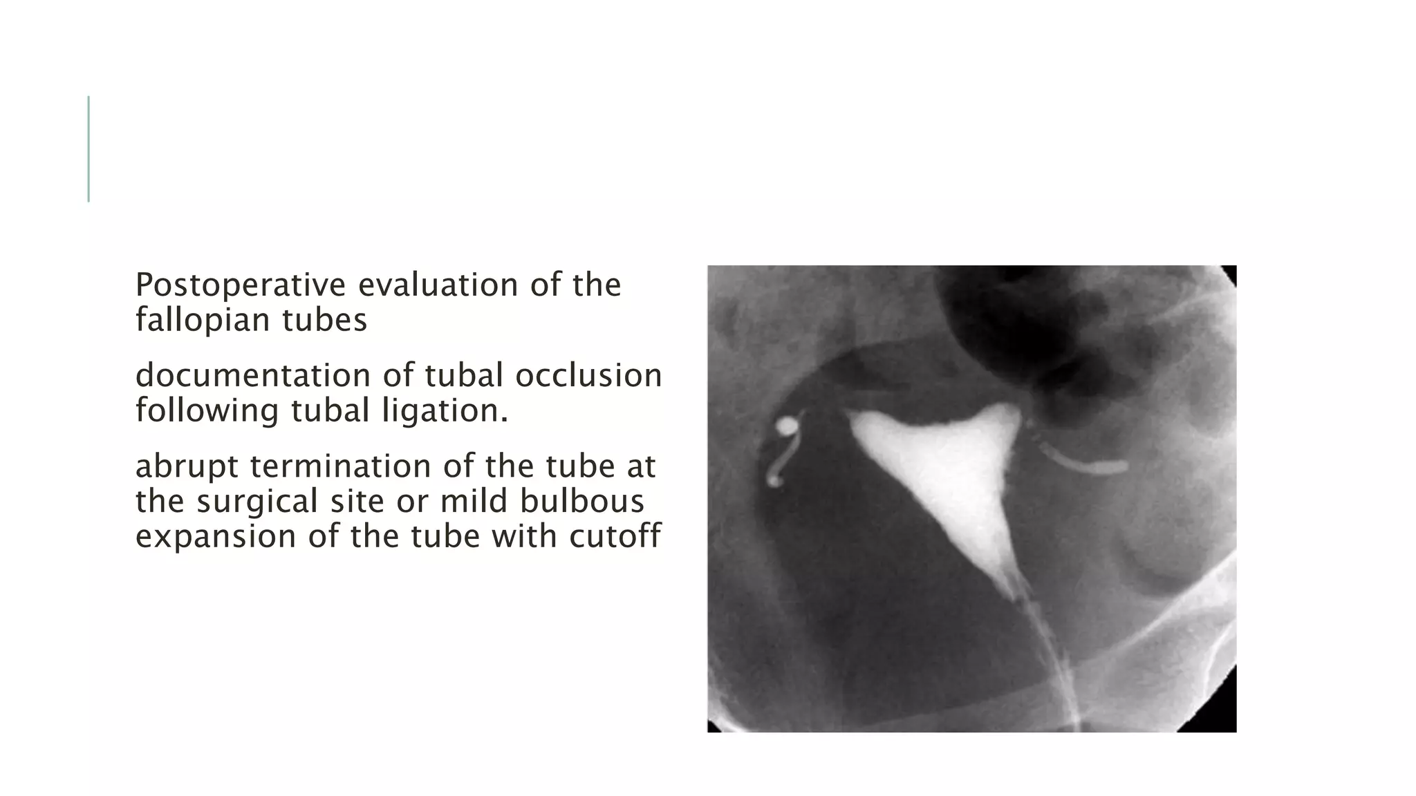 Fallopian tube Imaging Radiology | PPTX