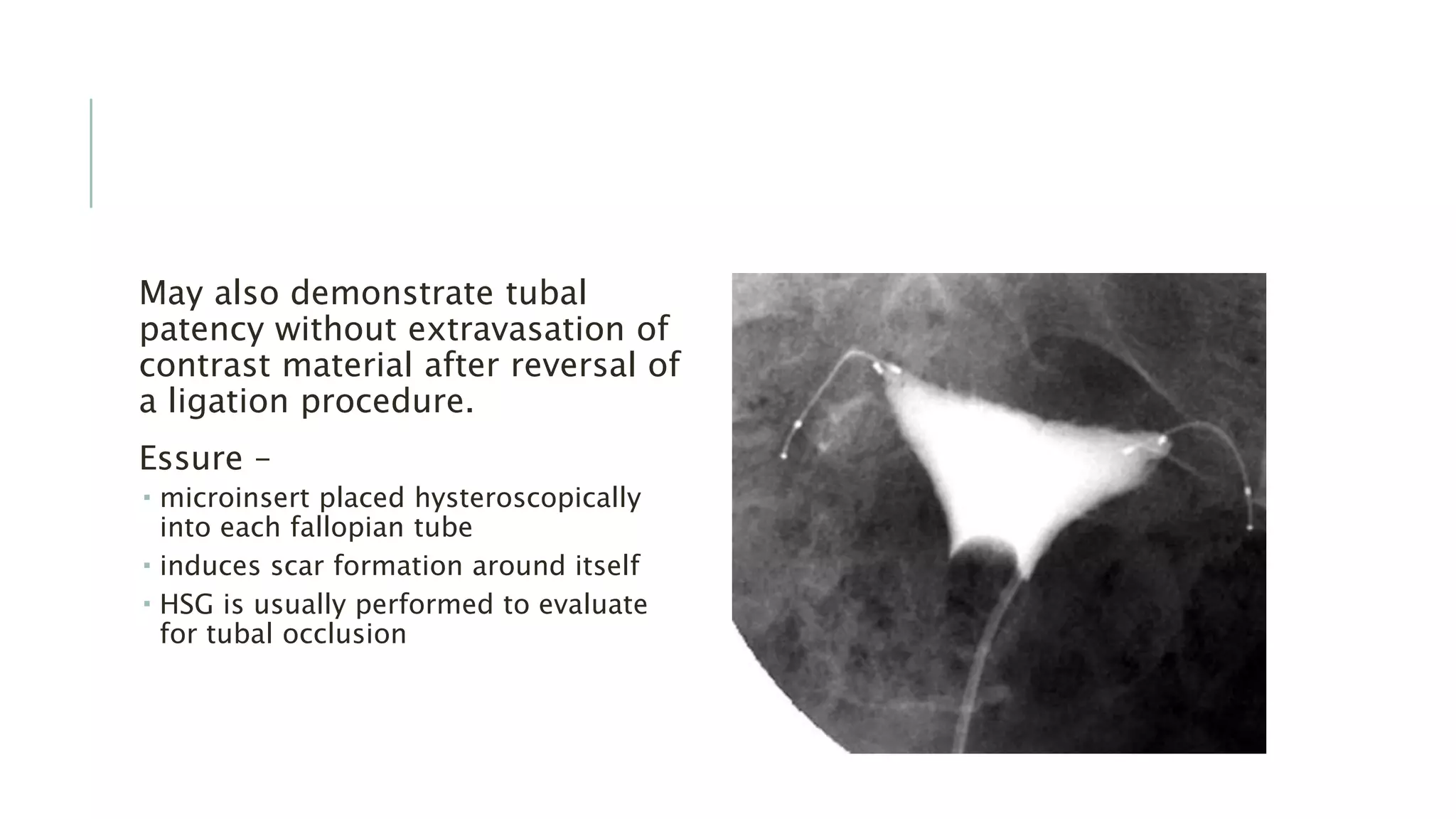 Fallopian tube Imaging Radiology | PPTX