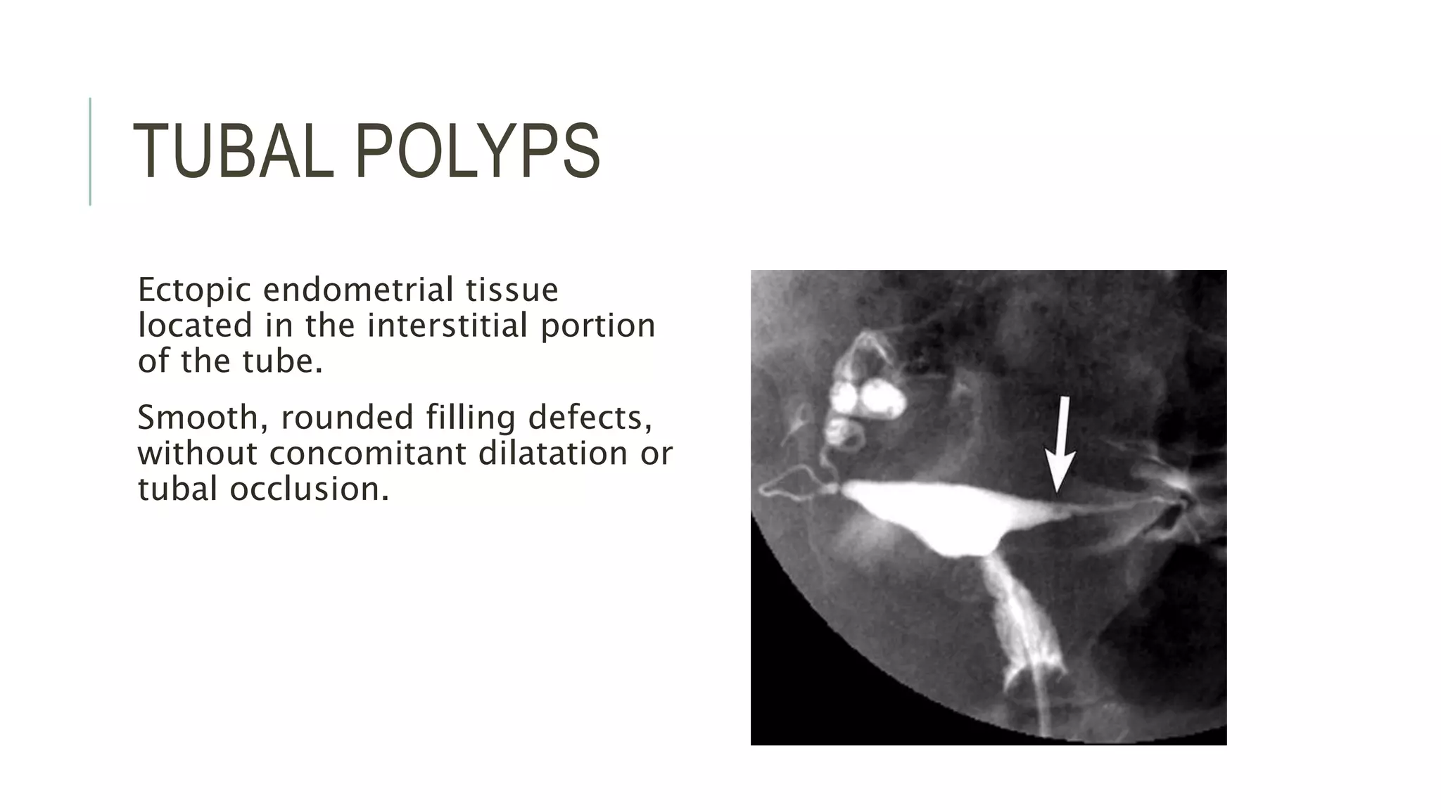 Fallopian tube Imaging Radiology | PPTX