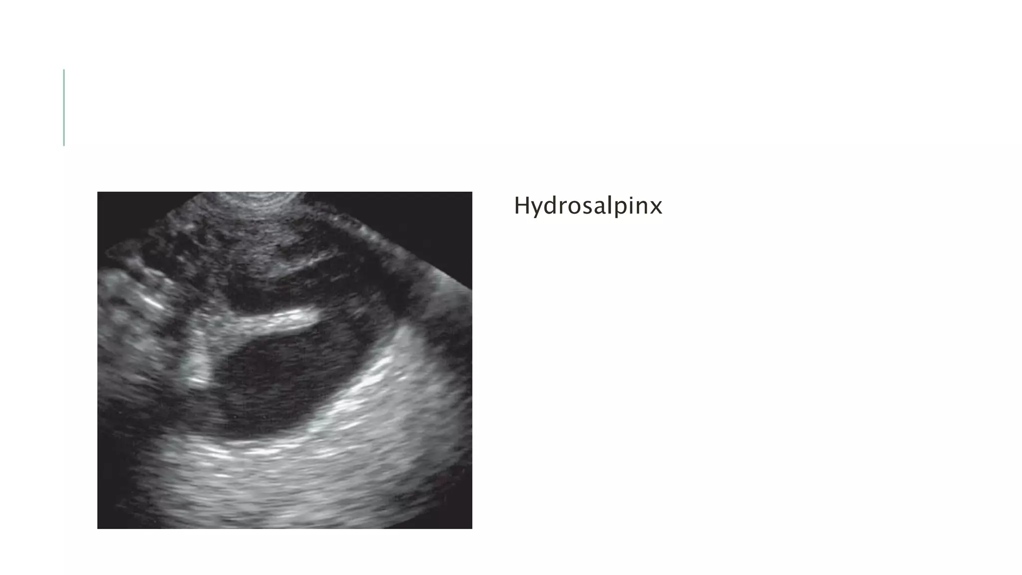 Fallopian tube Imaging Radiology | PPTX