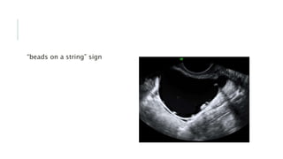 Fallopian tube Imaging Radiology | PPTX