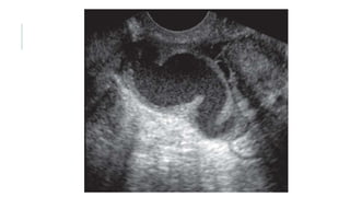 Fallopian tube Imaging Radiology | PPTX