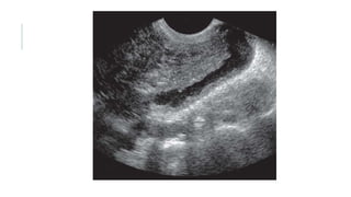 Fallopian tube Imaging Radiology | PPTX