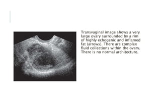Fallopian tube Imaging Radiology | PPTX