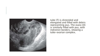 Fallopian tube Imaging Radiology | PPTX
