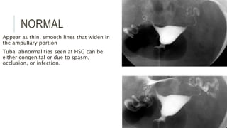 Fallopian tube Imaging Radiology | PPTX