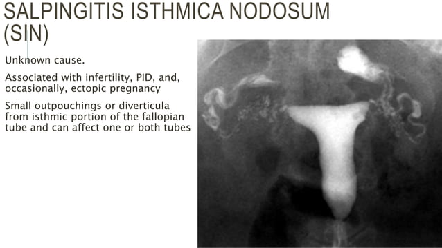 Fallopian tube Imaging Radiology | PPTX | Pregnancy | Reproductive Health
