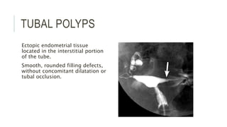 Fallopian tube Imaging Radiology | PPTX