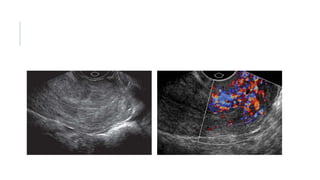 Fallopian tube Imaging Radiology | PPTX