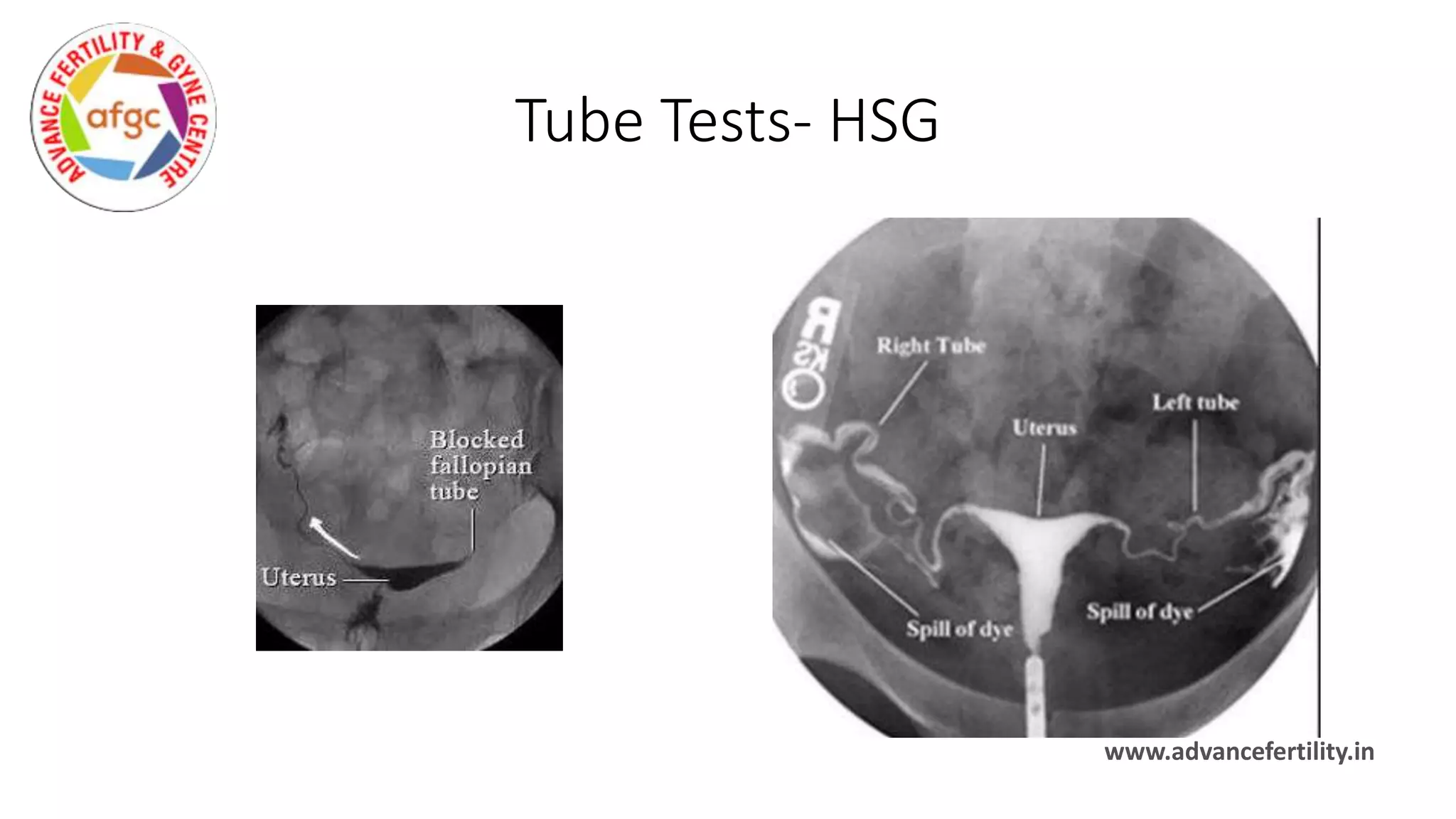 Fallopian tube blockage | PPTX