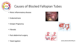 Fallopian tube blockage | PPTX