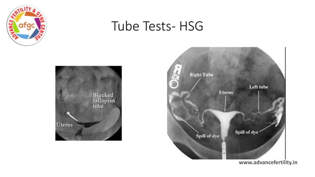 Fallopian tube blockage | PPTX