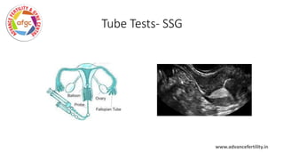Fallopian tube blockage | PPTX