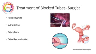 Fallopian tube blockage | PPTX
