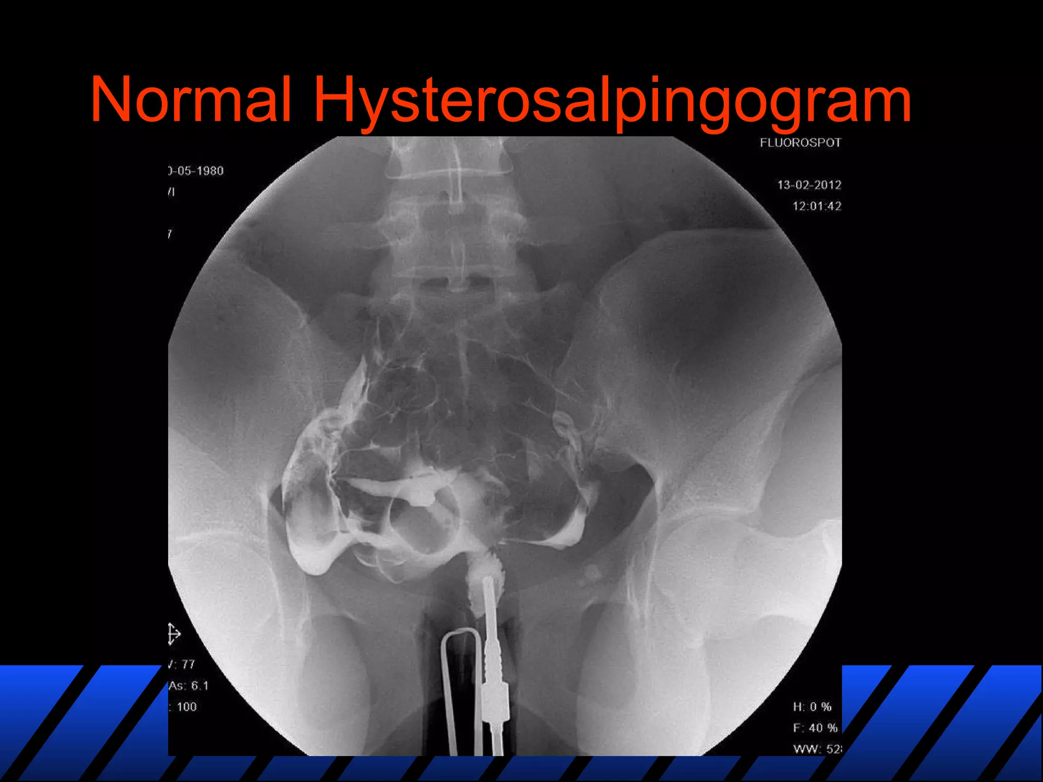 Fallopian tube radiology - Dr. Sumit Sharma | PPT