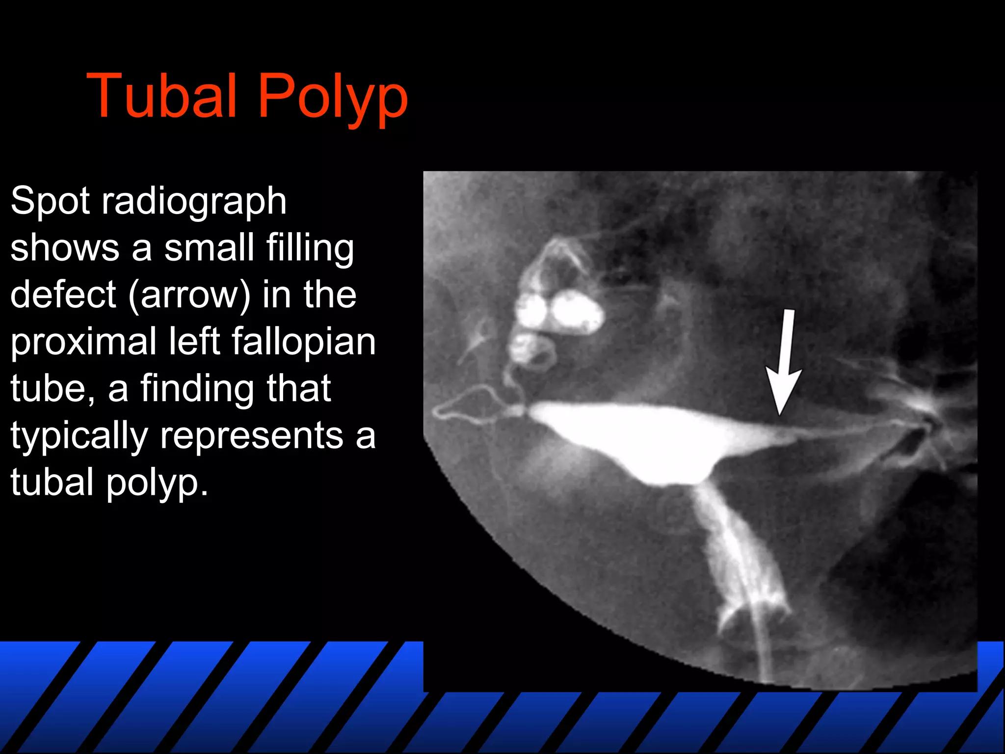 Fallopian tube radiology - Dr. Sumit Sharma | PPT