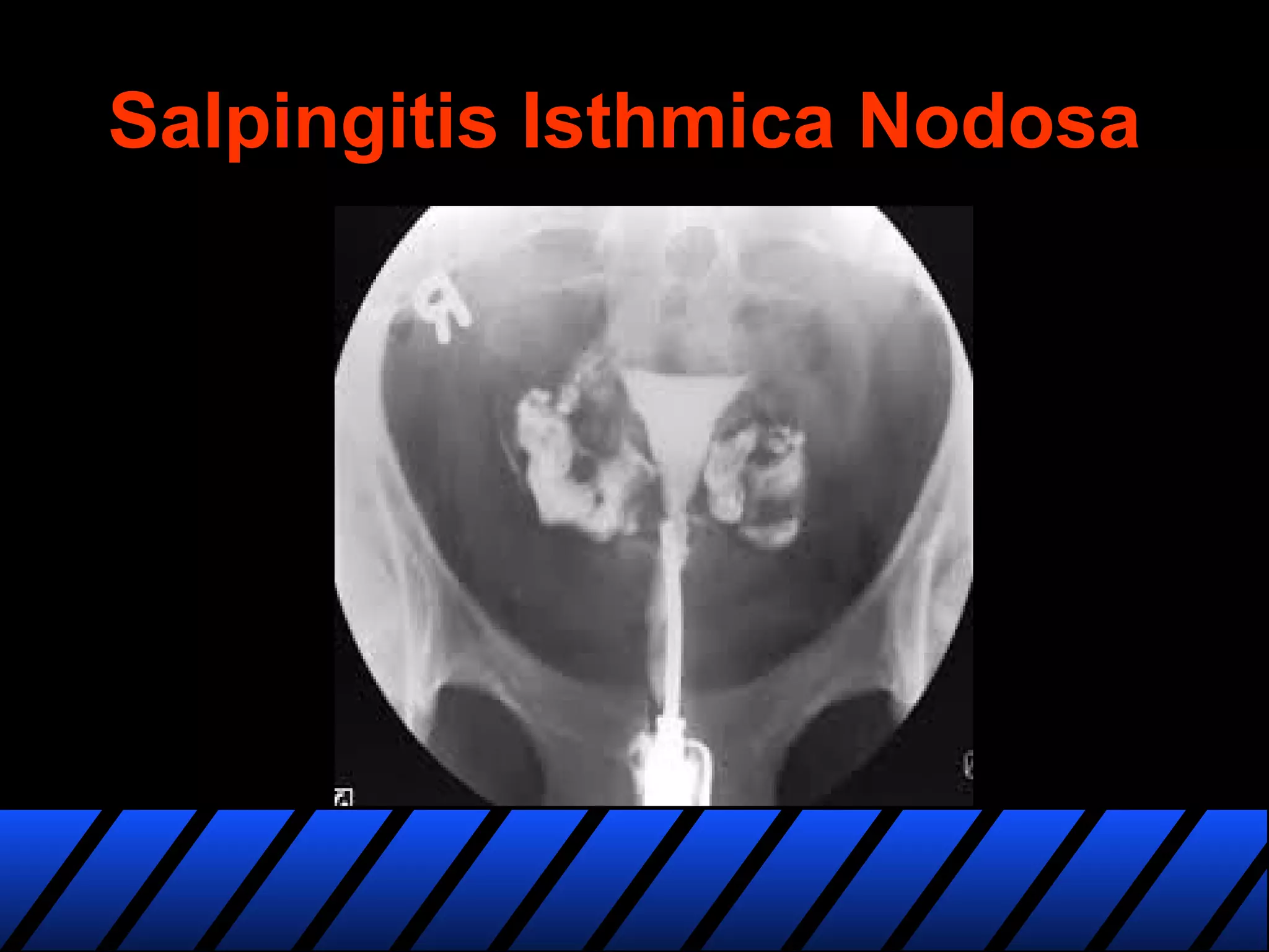 Fallopian tube radiology - Dr. Sumit Sharma | PPT