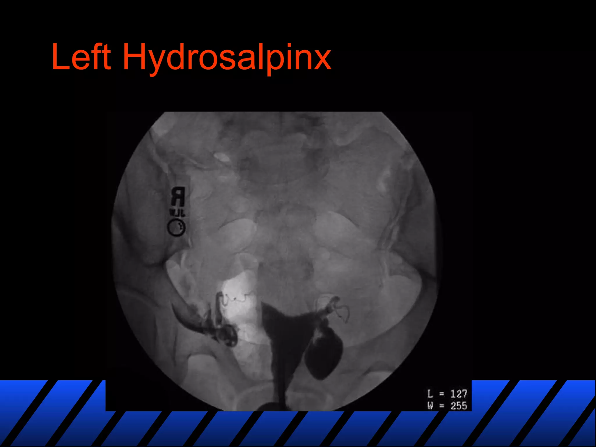 Fallopian tube radiology - Dr. Sumit Sharma | PPT