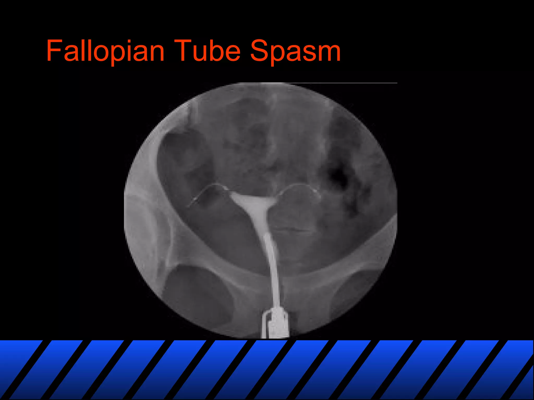 Fallopian tube radiology - Dr. Sumit Sharma | PPT