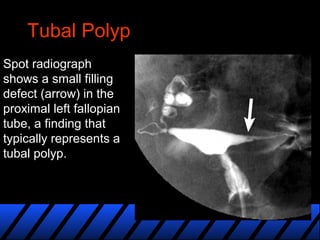 Fallopian Tube Anatomy Hsg