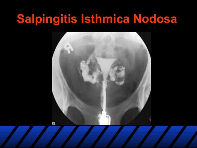 Fallopian tube radiology - Dr. Sumit Sharma