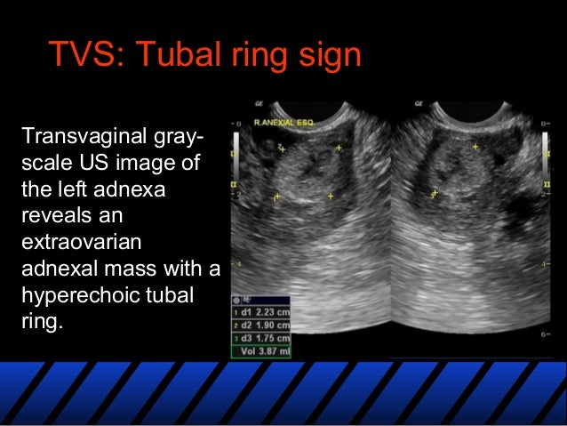 Fallopian tube radiology - Dr. Sumit Sharma